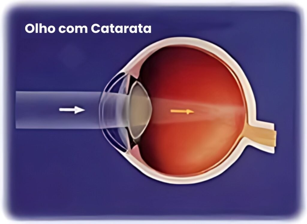 Cirurgia de Catarata – nassaroftalmologia.com.br